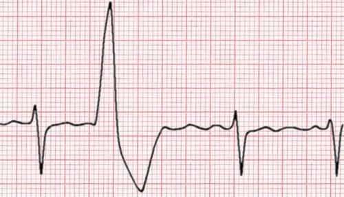 Basic ECG Interpretation (RACE 1.0 CEU)