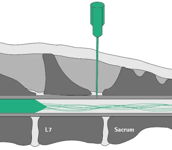 Locoregional Analgesia Blocks