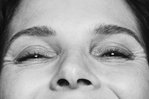 a retrospective analysis of the use of caha in the upper third of the face