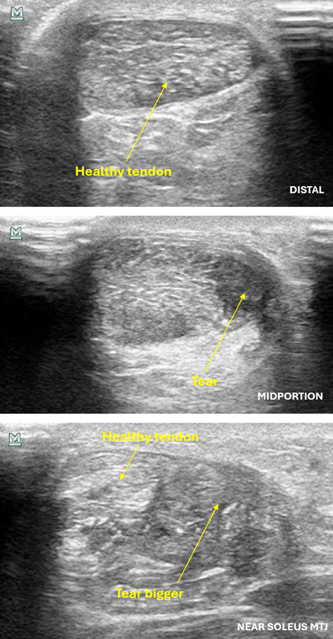 What do Achilles partial tears look like?