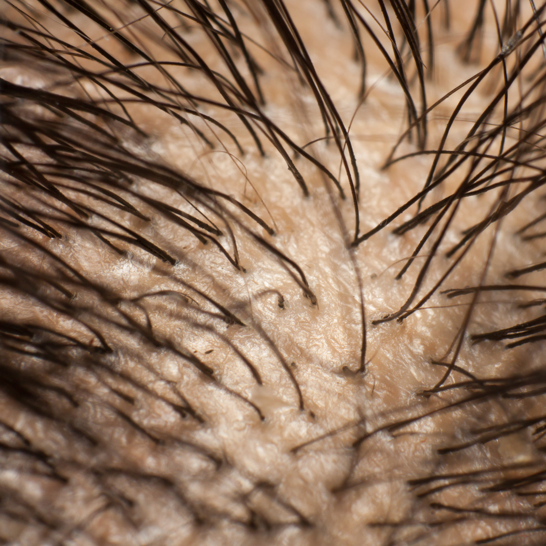 Hair Loss Diagnosis Using Trichoscopy