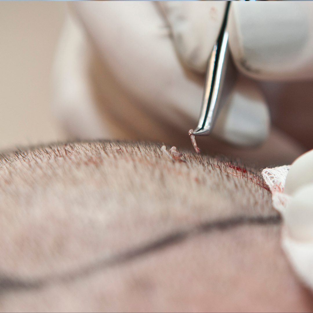 Hair Transplant Complications and Solutions