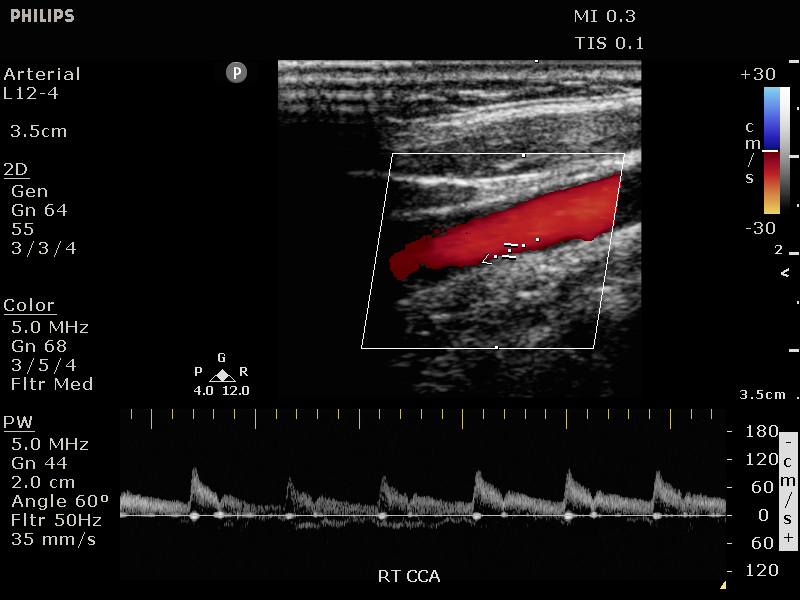 Doppler Ultrasound: $50 Online POCUS Course and Earn CME