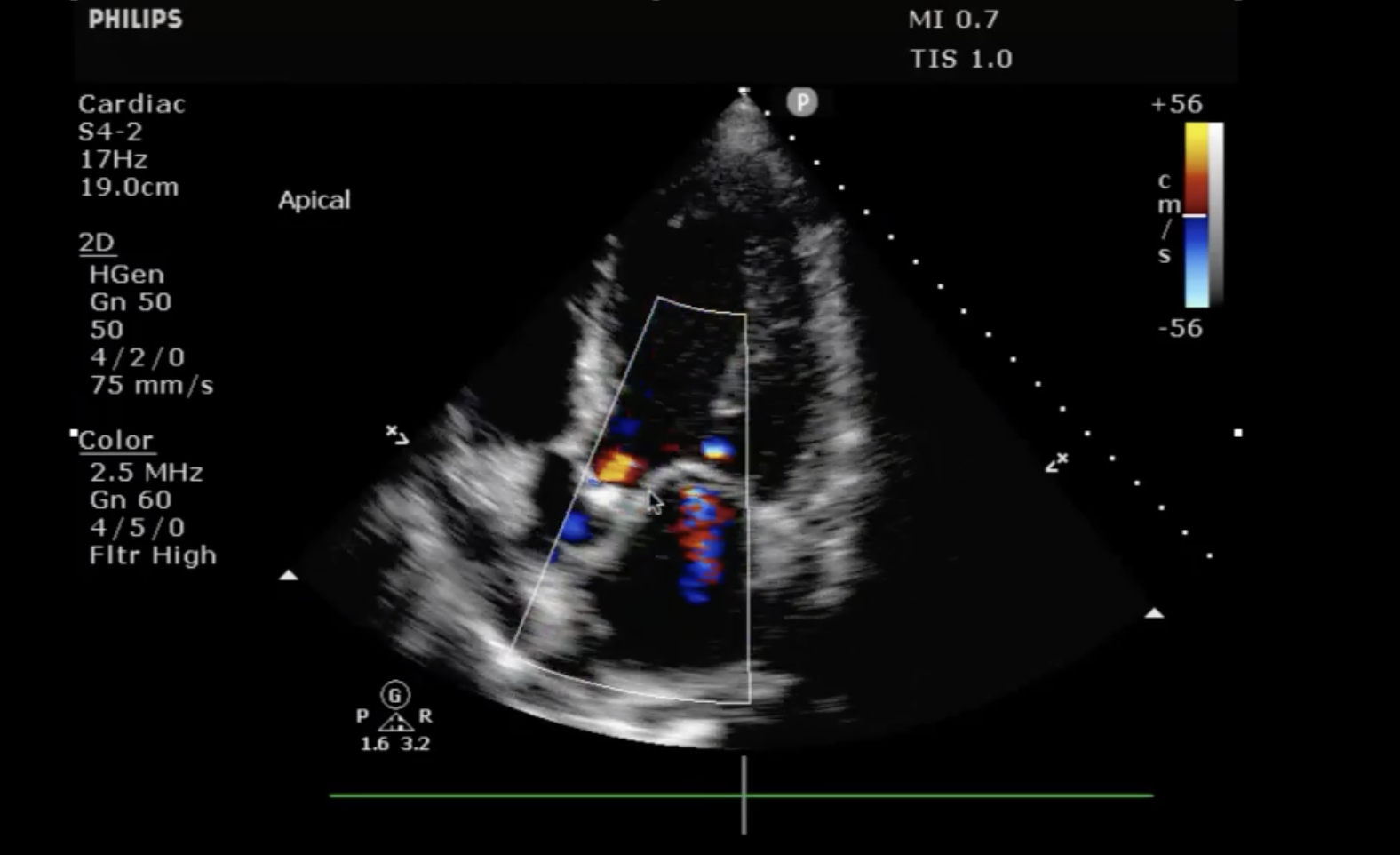Advanced Cardiac Ultrasound: A Step-by-Step POCUS Course