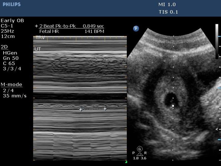 First Trimester Ultrasound Online POCUS Course