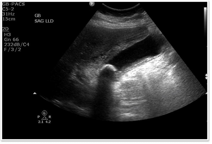 Gallbladder Sonography Online POCUS Course