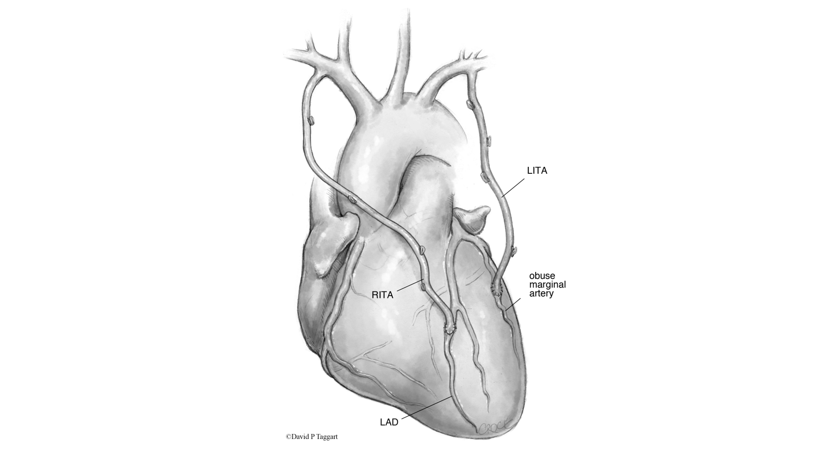 TTFM in CABG Surgery