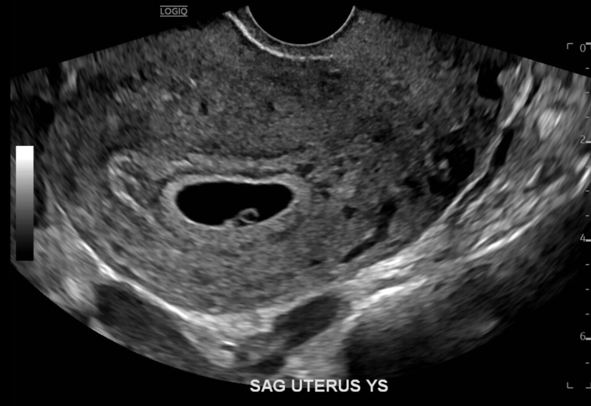 Hospitalist & Primary Care First Trimester OB Online POCUS Course