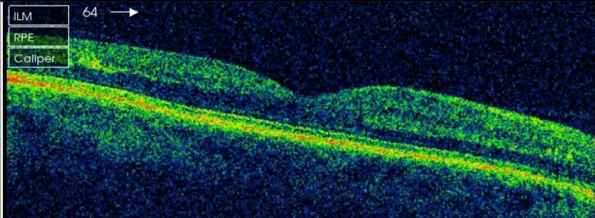 Optical Coherence Tomography (OCT) Interpretation