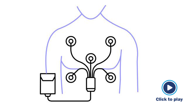 ACM: 2-Holter Monitors