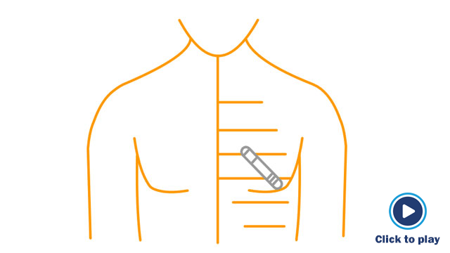 Implantable Loop Recorders