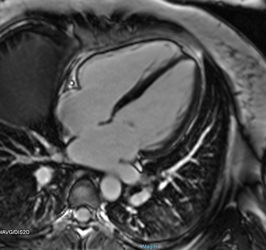 Cardiac MRI - Intermediate