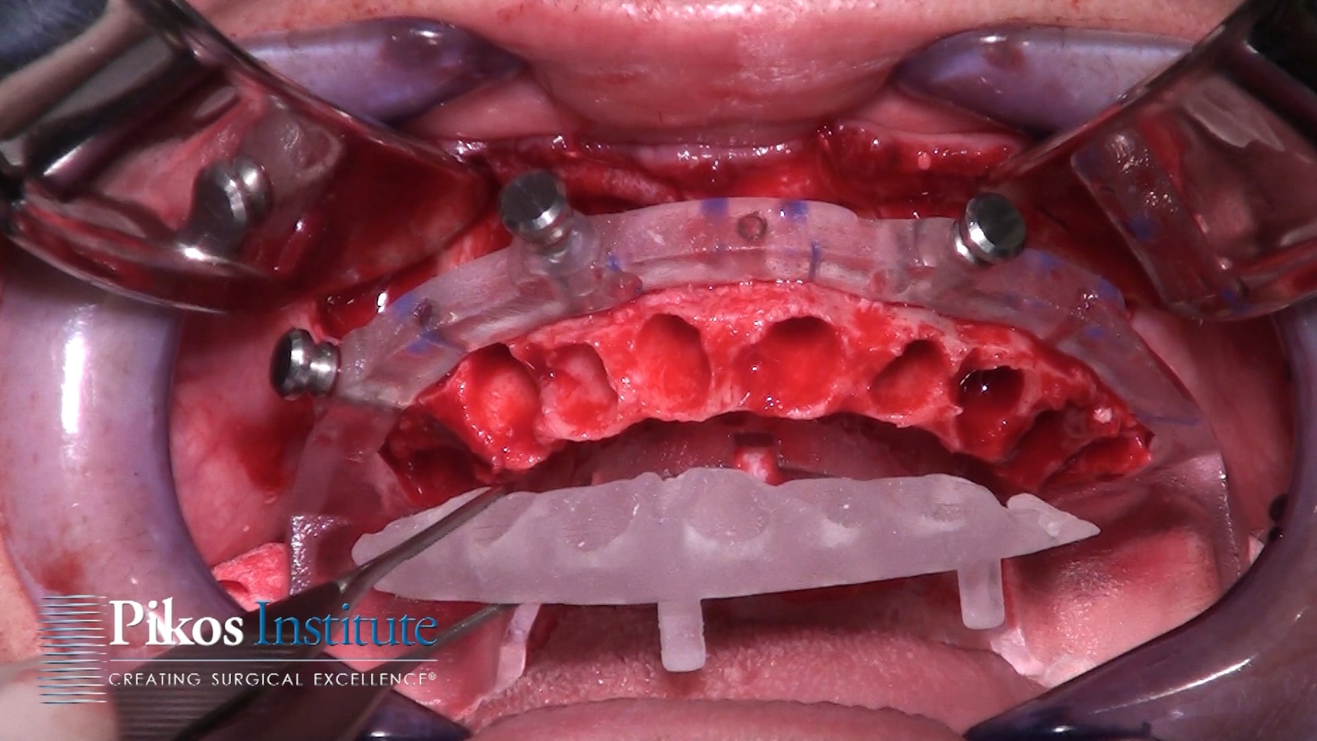 Fully Guided Full Arch Immediate Implant Reconstruction (Surgical Video Series)