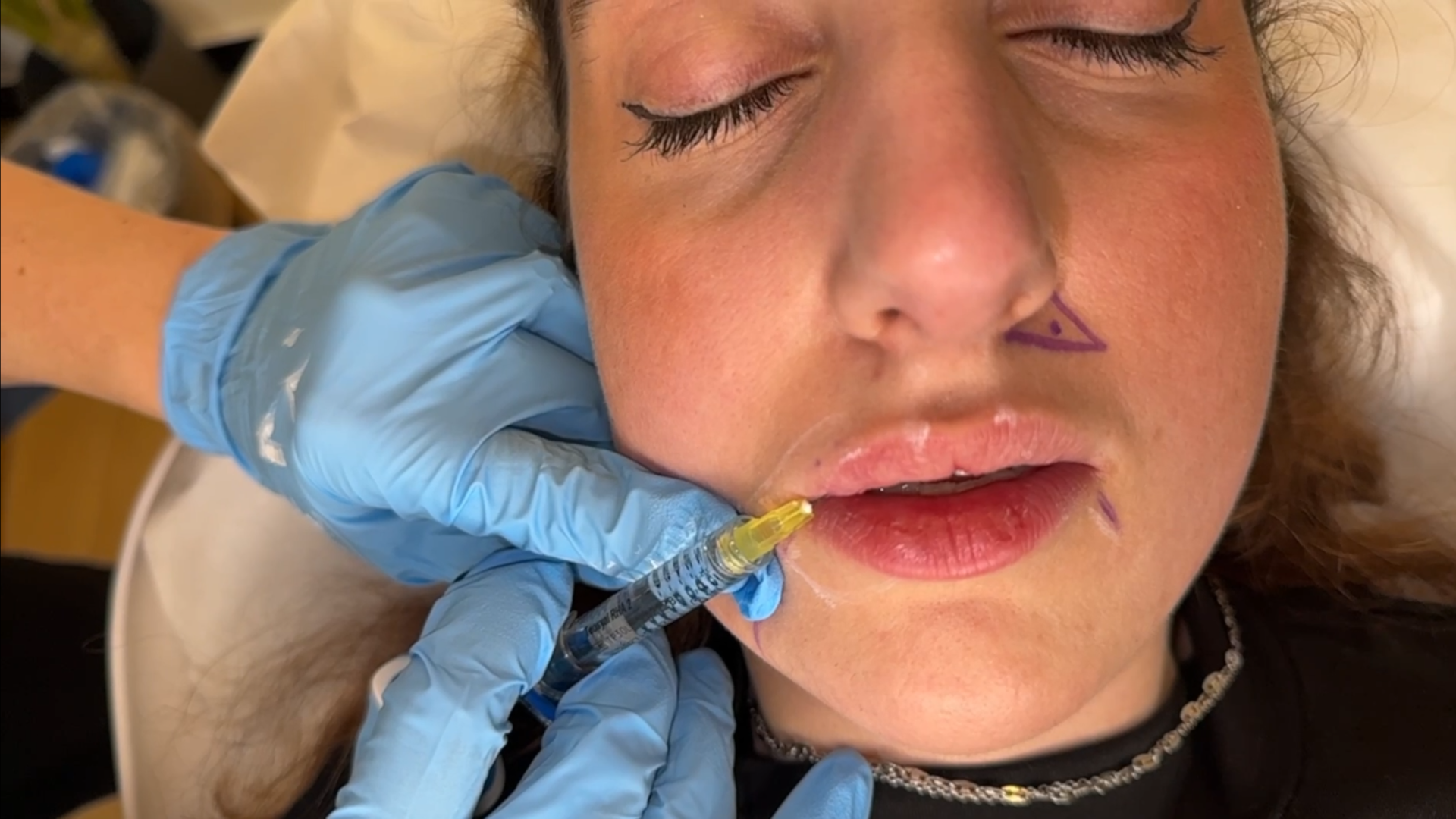 The Art and Science of Lip Enhancement | Online Dermal Fillers Training ...