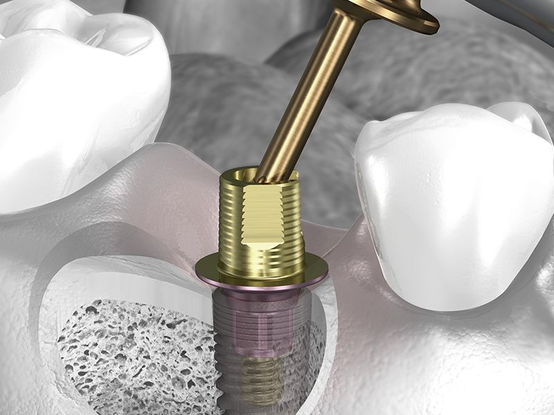 Digital Implantology Using Engaging Abutments