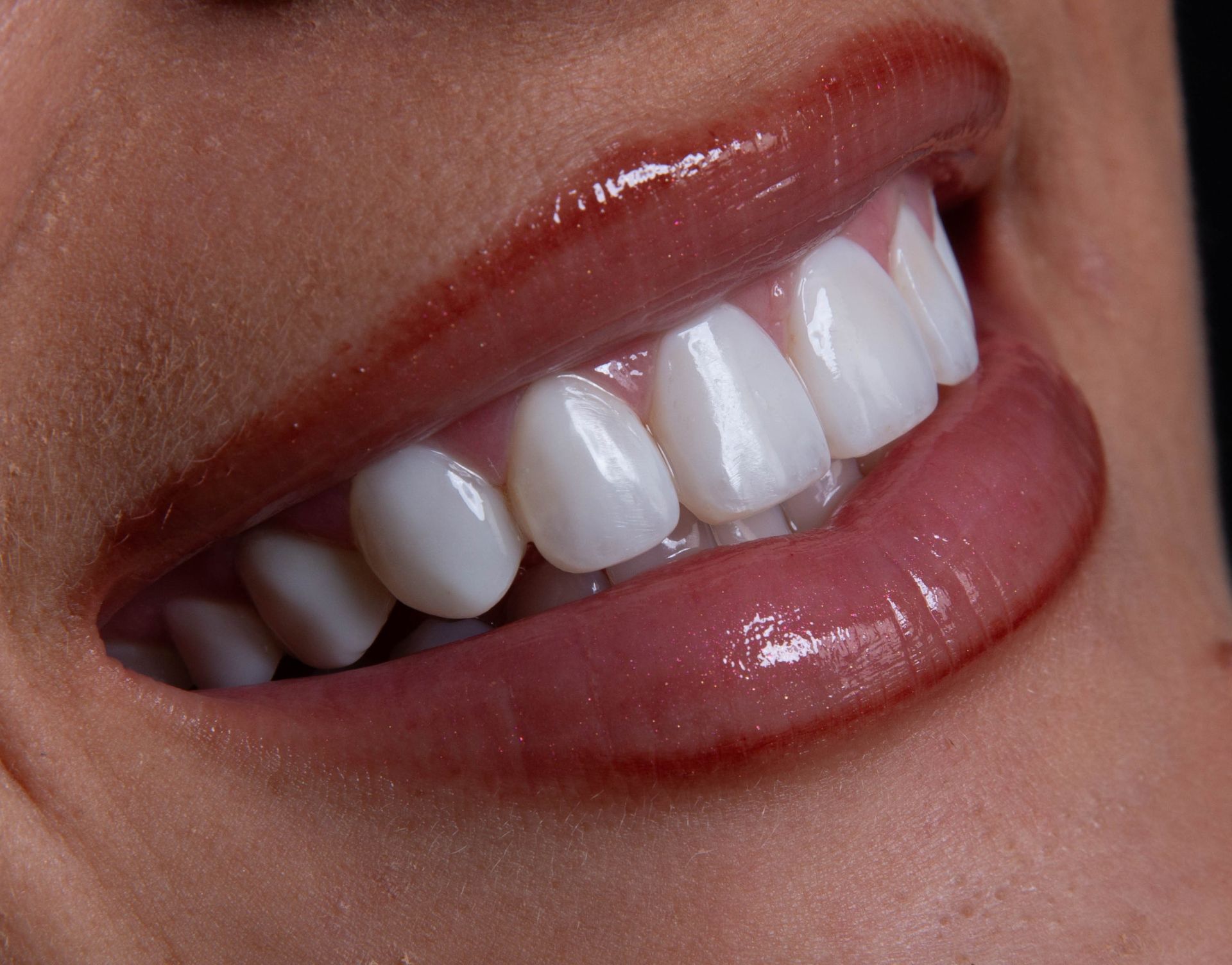 Composites for Conservative Dentistry