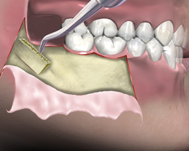 Flap Design and Suture Techniques for Implant Surgery