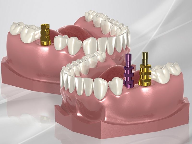 Closed Tray vs. Open Tray Dental Implant Impressions