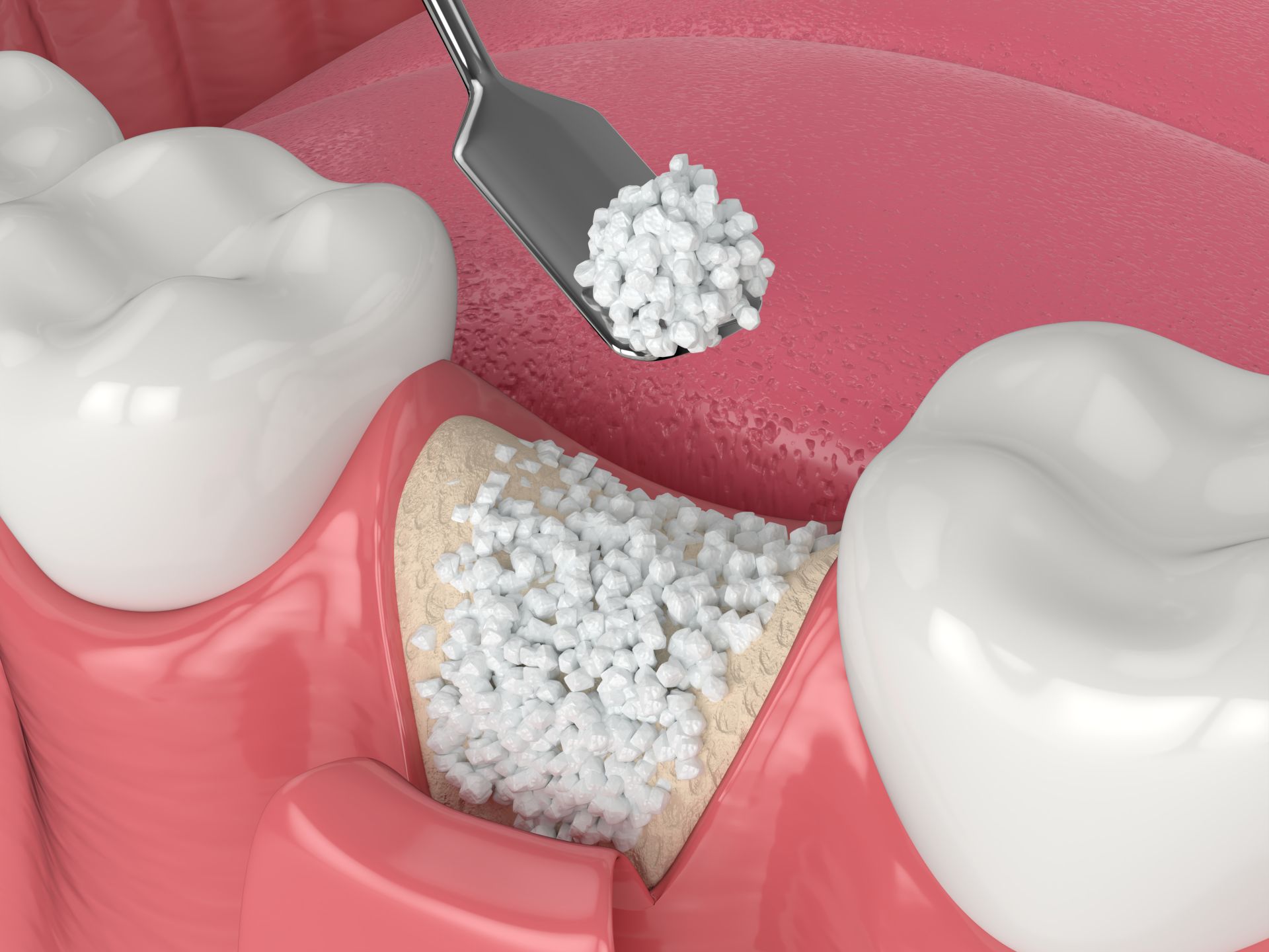 Grafting and Guided Bone Regeneration Techniques for Basic Implantology