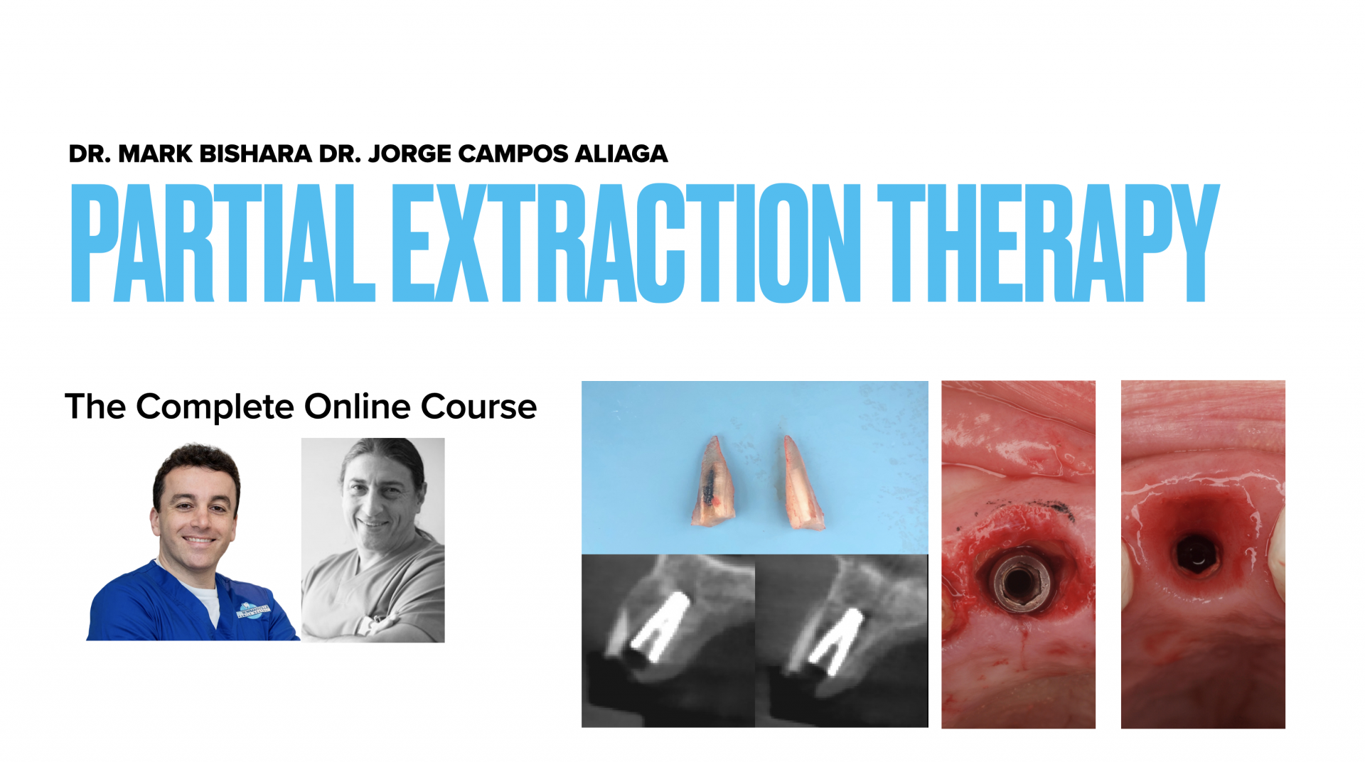 Partial Extraction Therapy for Implants - By Mark Bishara