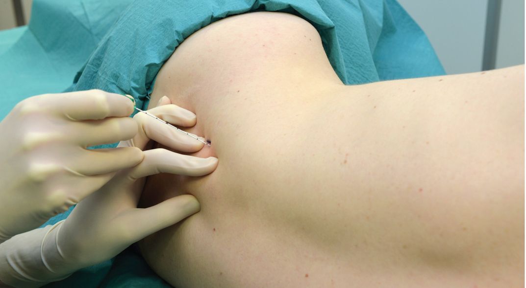 Lumbar Plexus Block – Landmark Technique