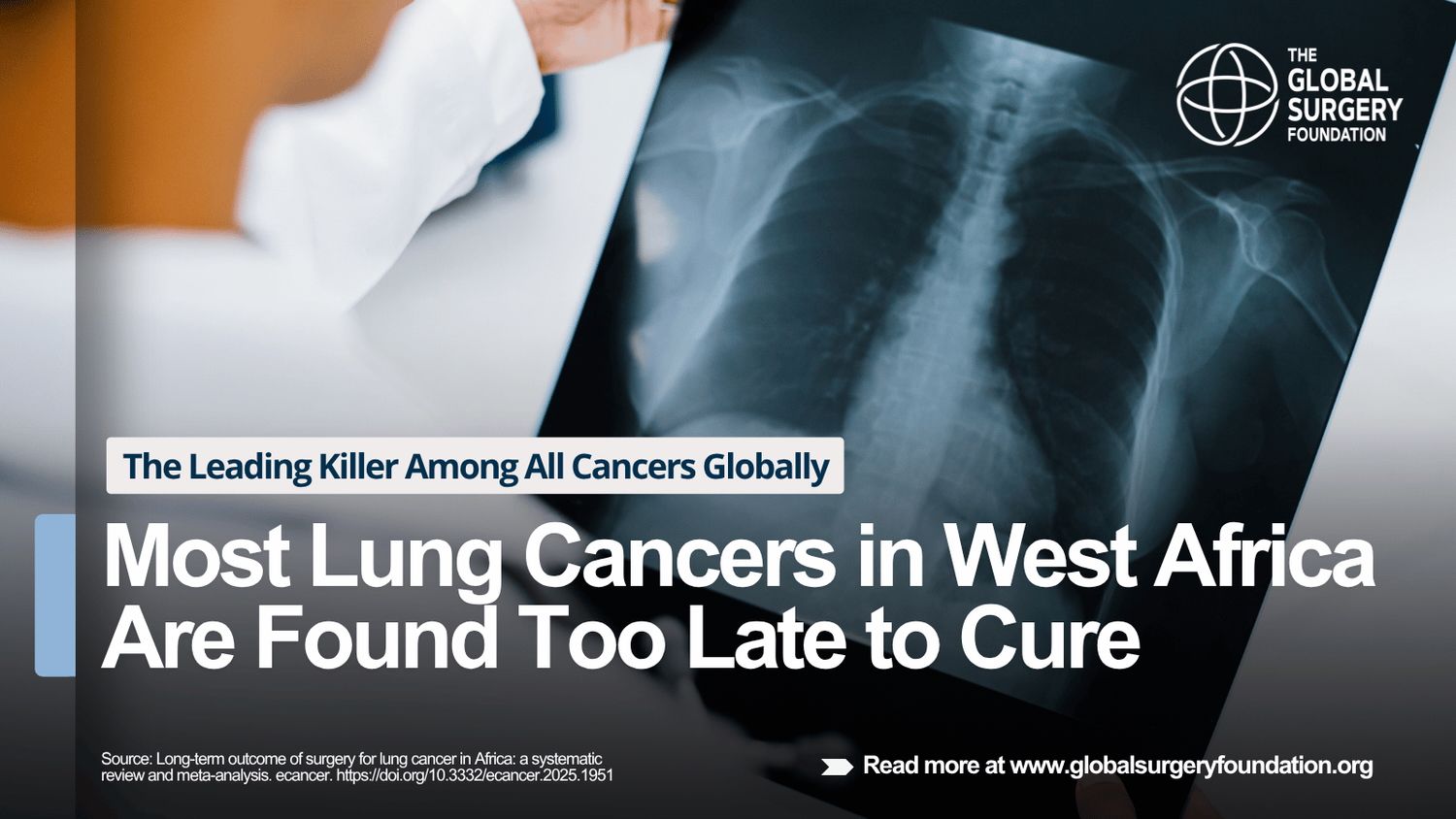 Too Late for Surgery: The Lung Cancer Crisis in Low-Resource Settings