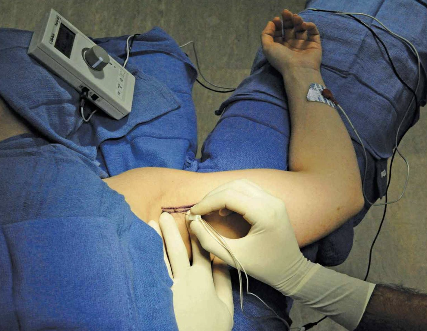 Nerve Stimulation for Peripheral Nerve Blockade - free online course