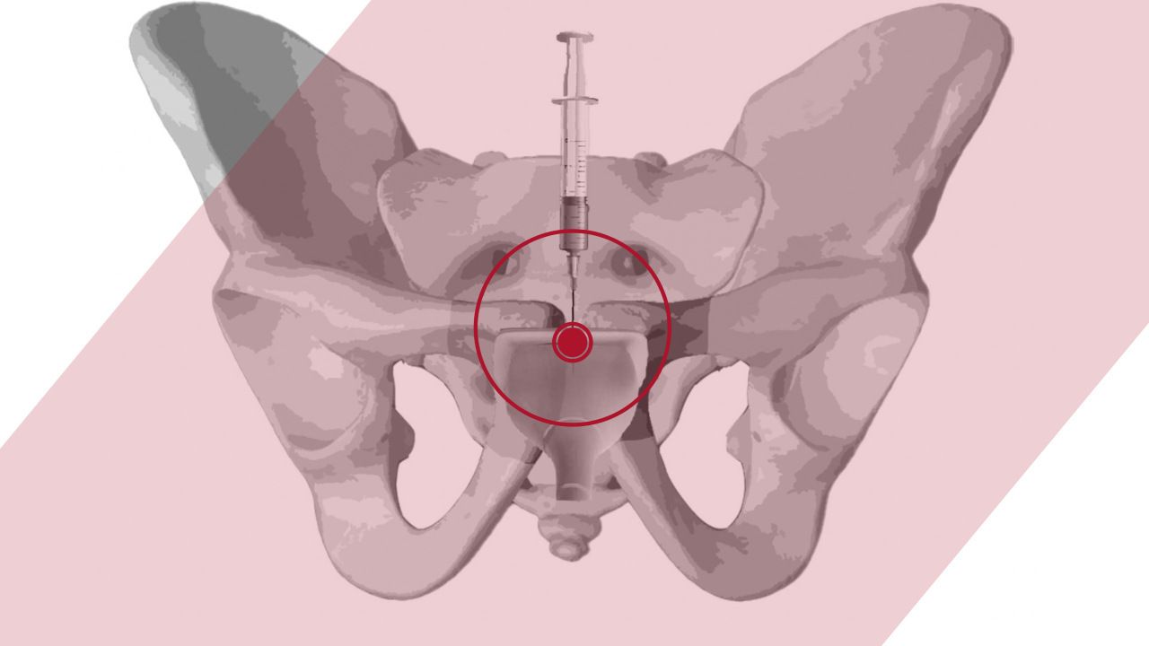 Les interventions guidées par l’image dans les blessures des muscles du ...