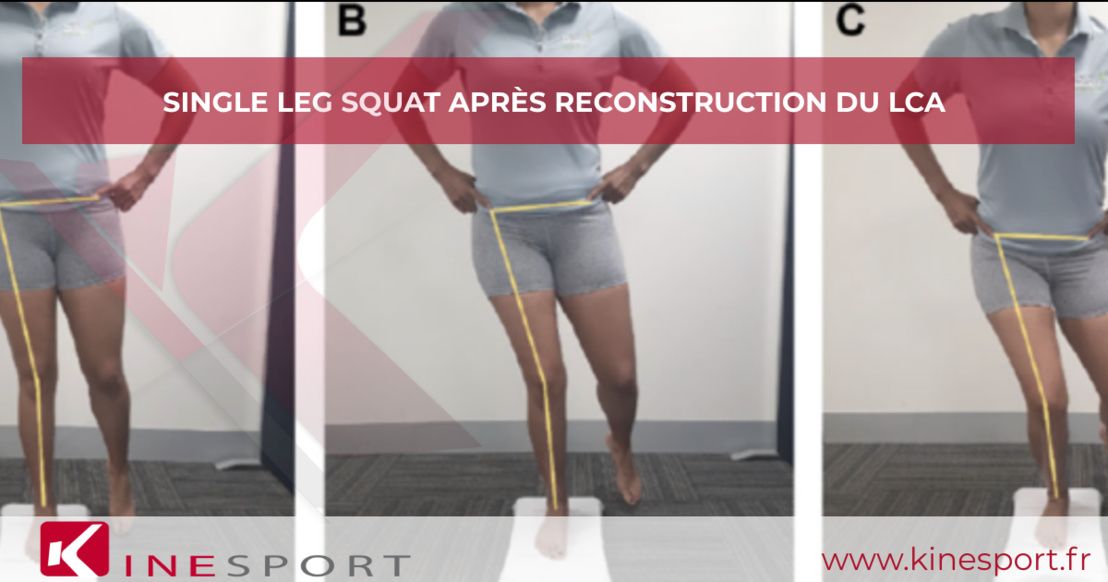 SINGLE LEG SQUAT ET RECONSTRUCTION DU LCA - Blog Kinesport