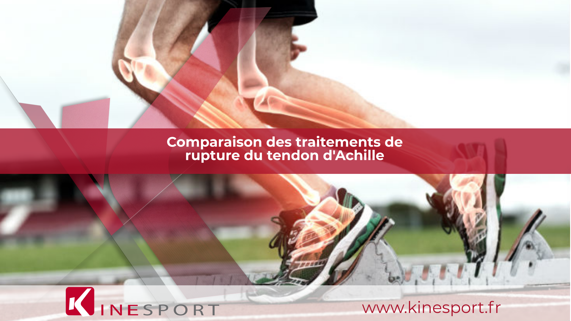 Comparaison des traitements de la rupture du tendon d'Achille - Blog ...