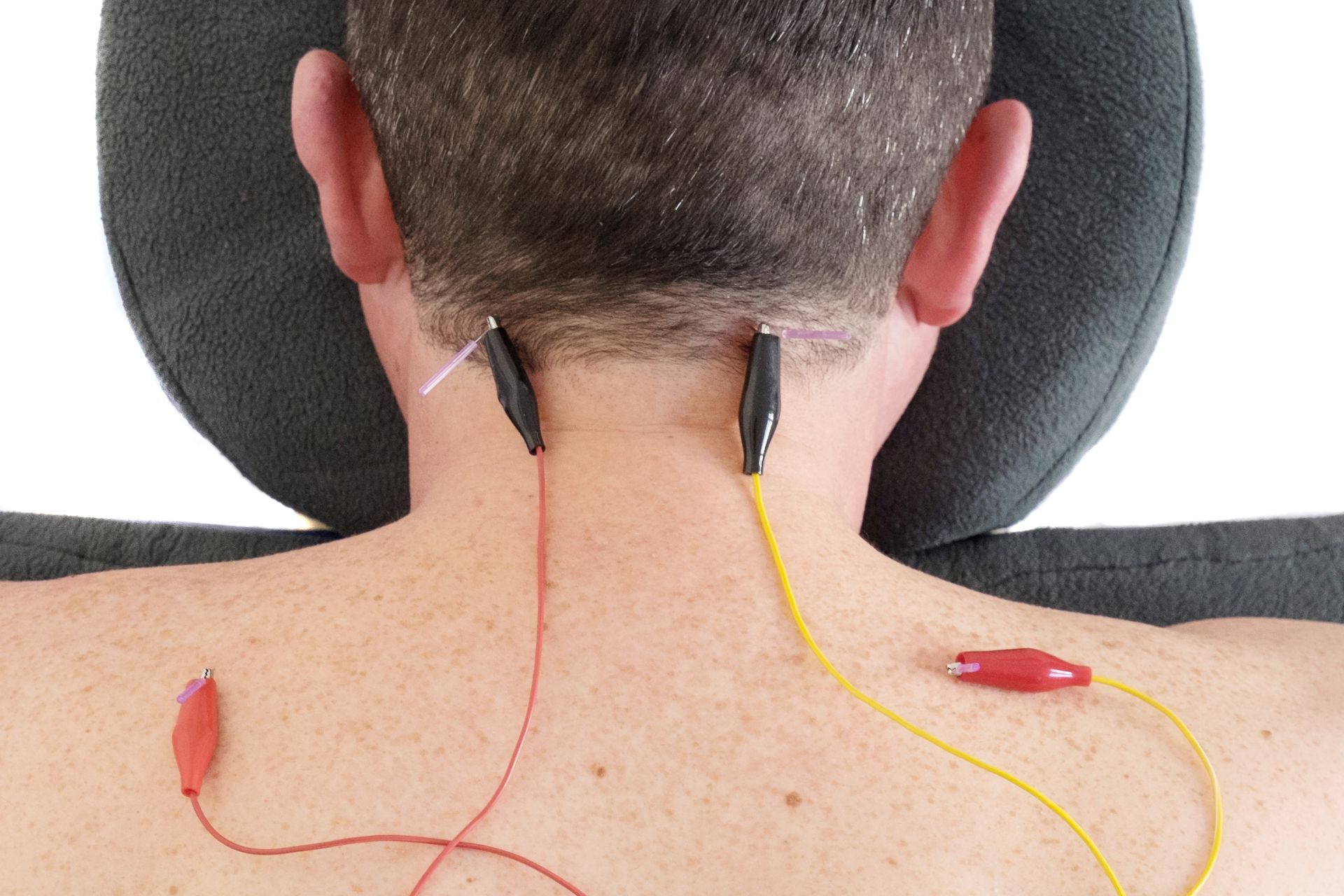 Diploma in Electro-Acupuncture (EA) & Electro-Dry Needling (EDN)