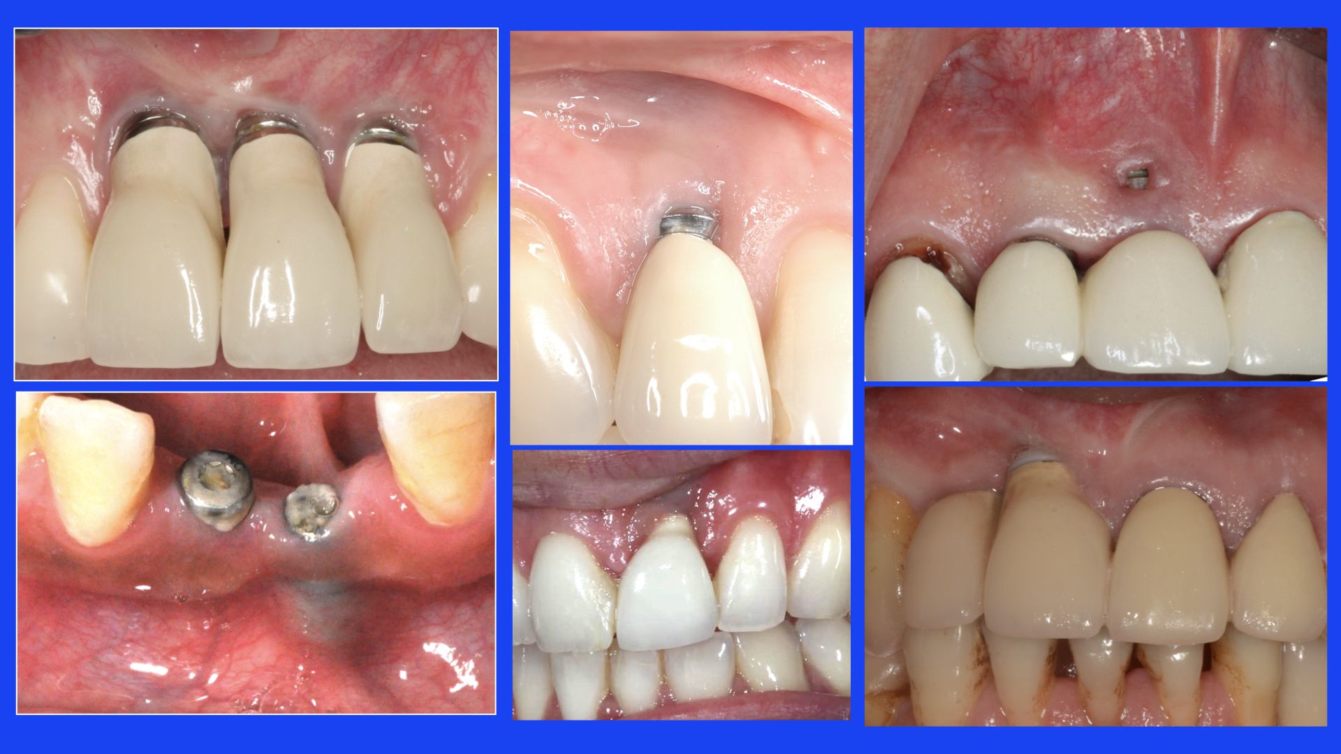 Managing soft tissue "Aesthetic" complications