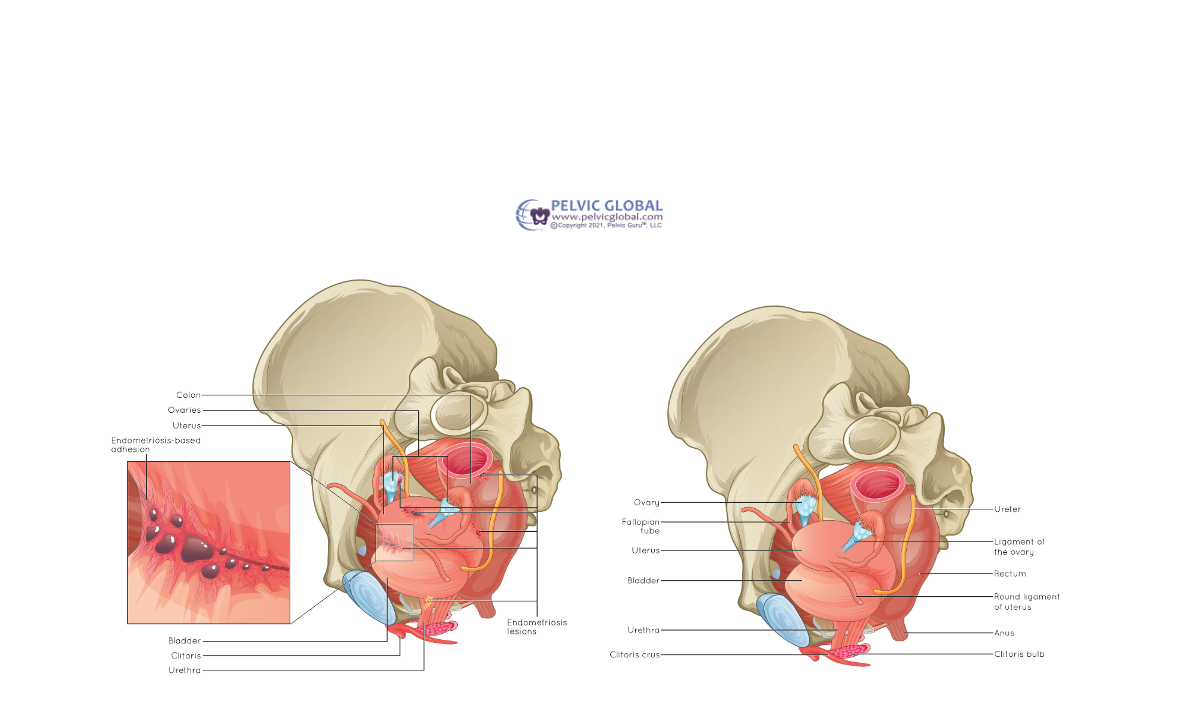 Uterus, Bladder, with and without Endometriosis, Pathology