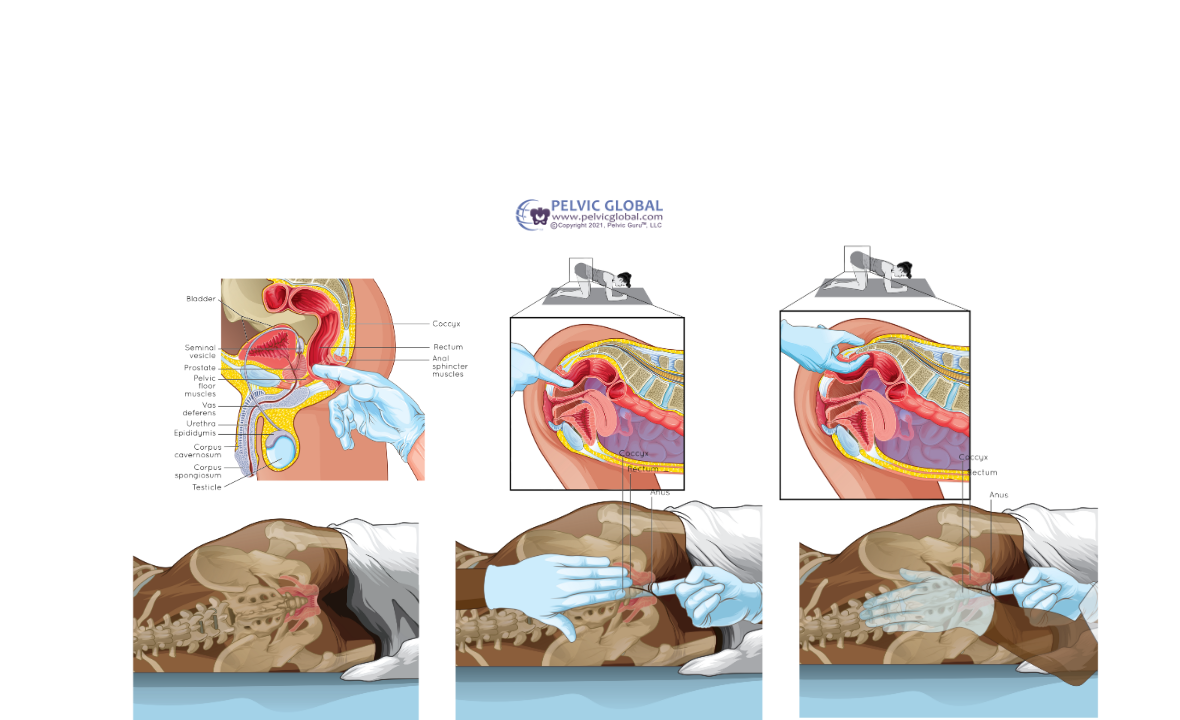 Coccyx, Rectum (Rectal) & Prostate Palpation, Sidelying, Prone, Supine Positions