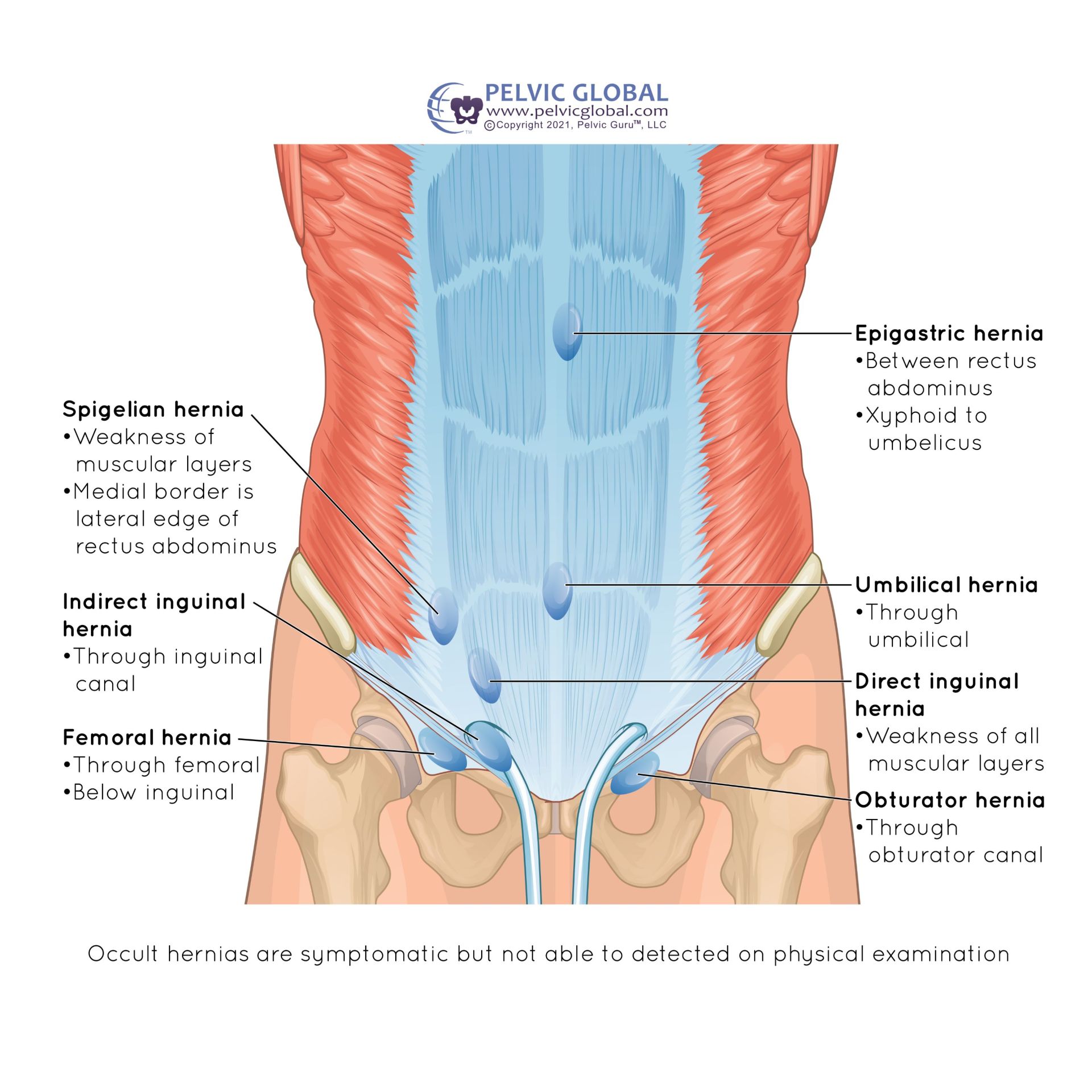 Hernias Inguinal Femoral Spigelian Obturator Epigastric Umbilical Hernias Inguinal Femoral Spigelian Obturator Epigastric Umbilical