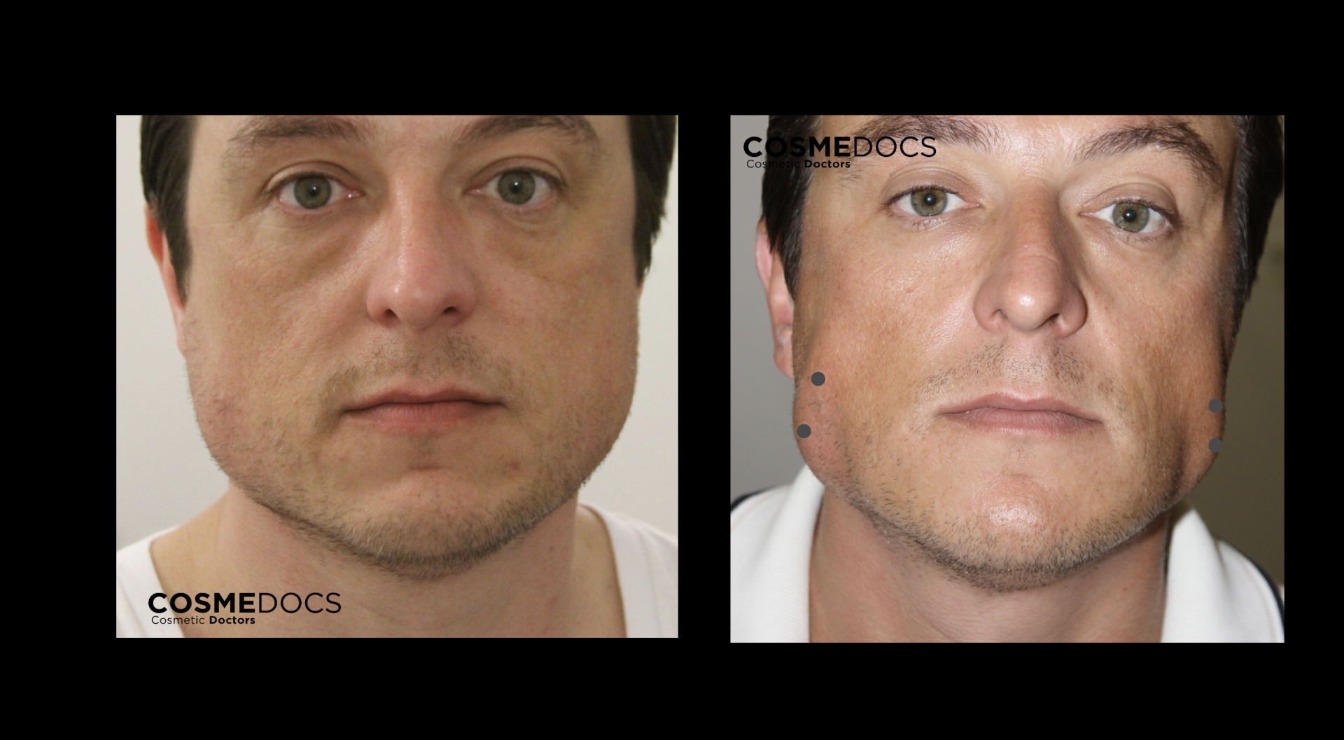 Unmasking the Mystery: Why Dentists Are Cautious with Masseter Botox ...