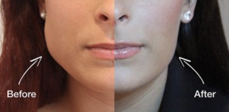 Online Masseter Botox Course For Wide Jaw, Bruxism and TMJ