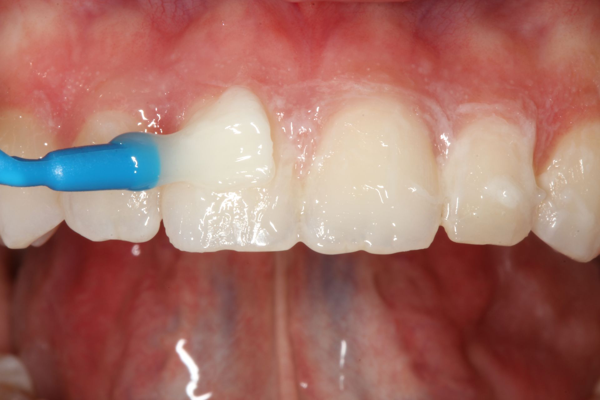 Oral Health And Prevention