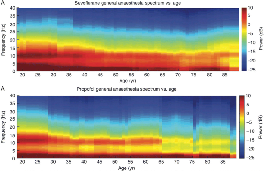 EEG Monitoring in Anesthesia