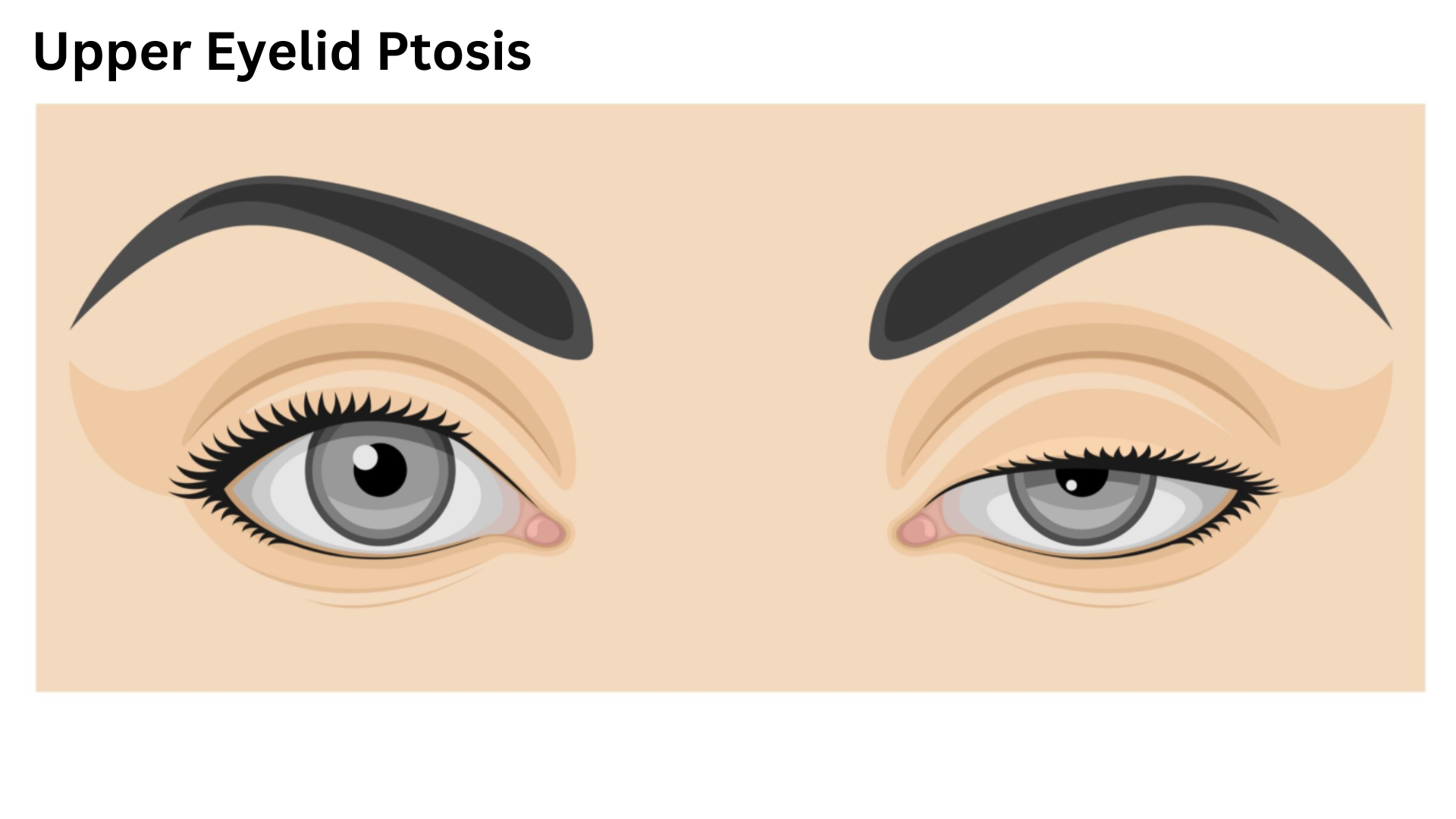 Upper Eyelid Ptosis