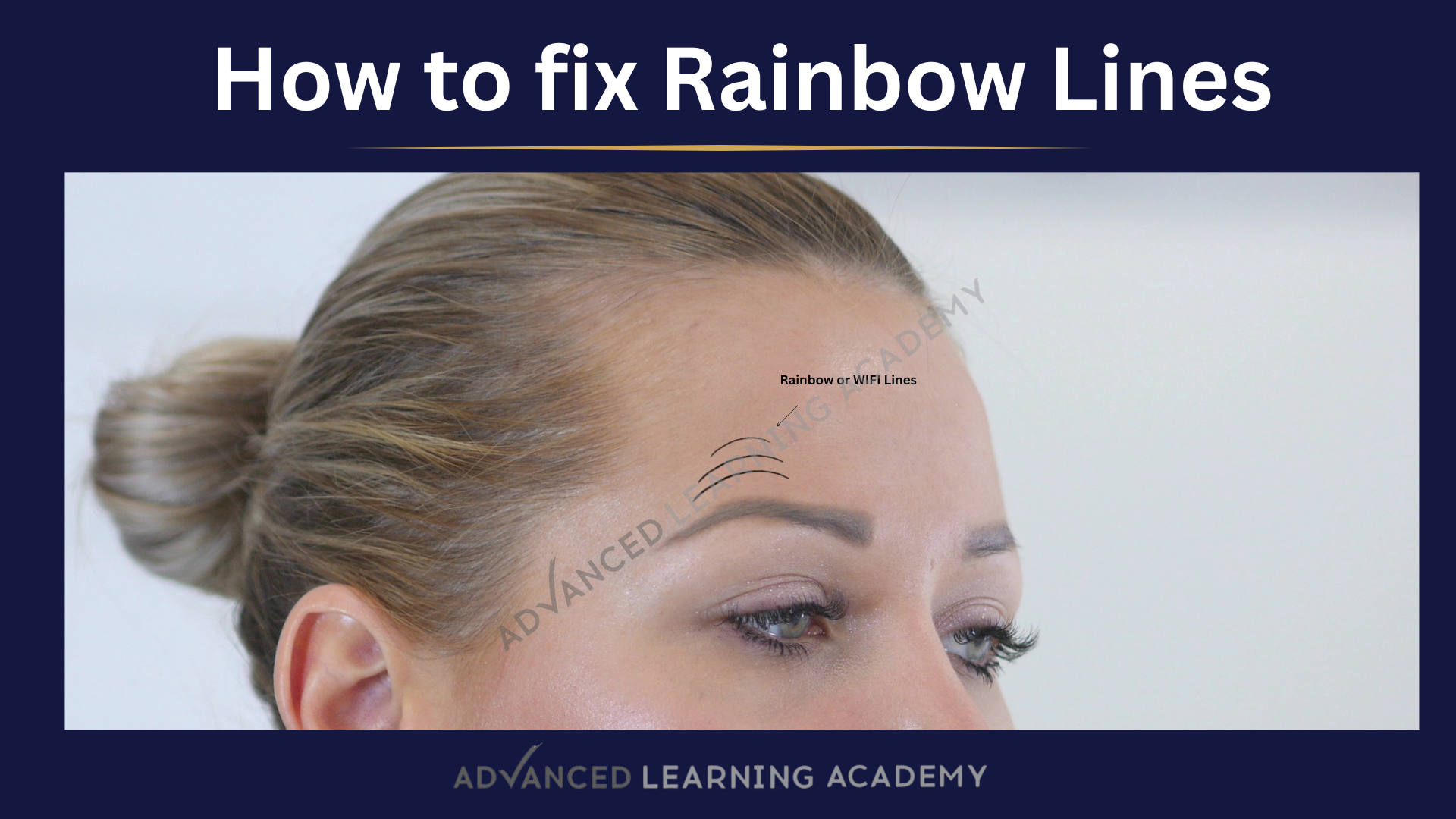 How to Recognise and Correct Rainbow Lines After Botulinum Toxin Treatment