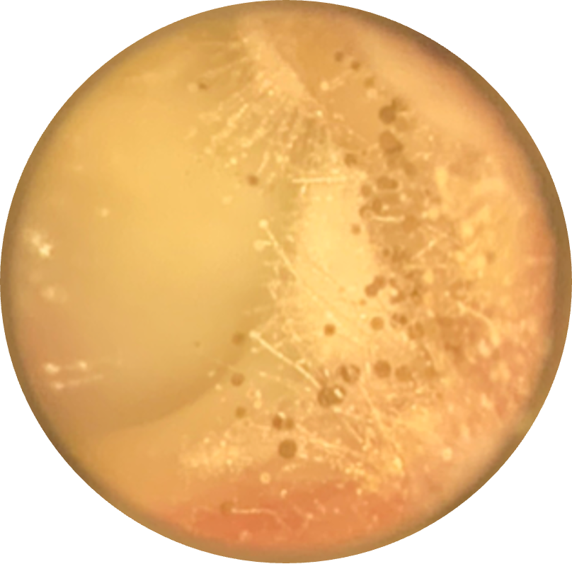 Acute Otitis Externa: Media Variations