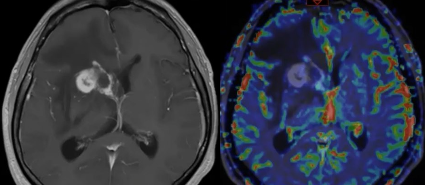 Neuroradiology: MR Perfusion for Brain Tumours